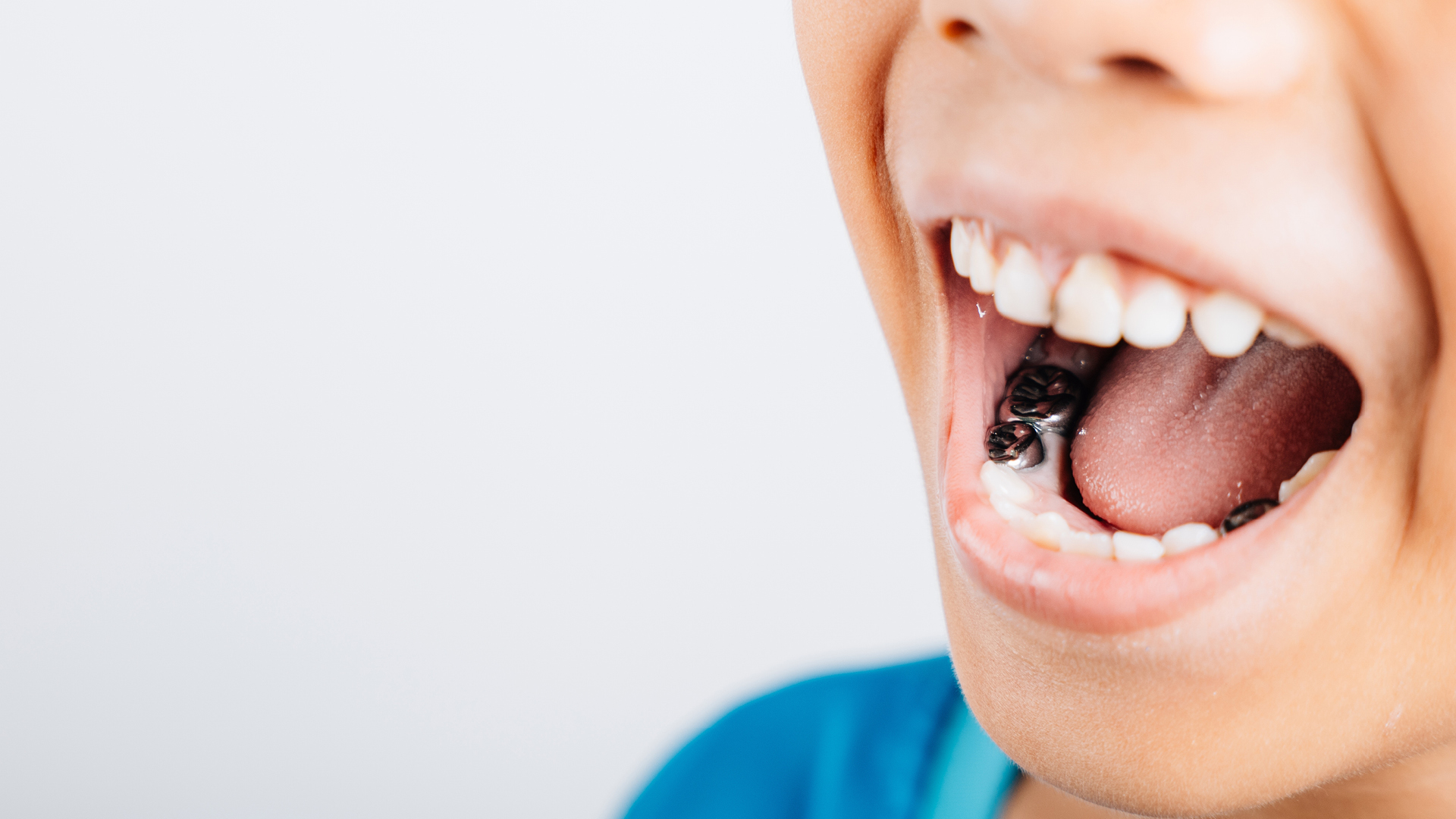 Pulpotomy, Hall Technique and MIH: From Diagnosis to Definitive Care ...